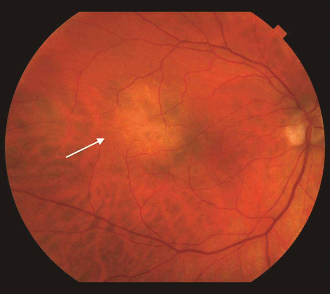 Retinal Amelanotic Melanoma