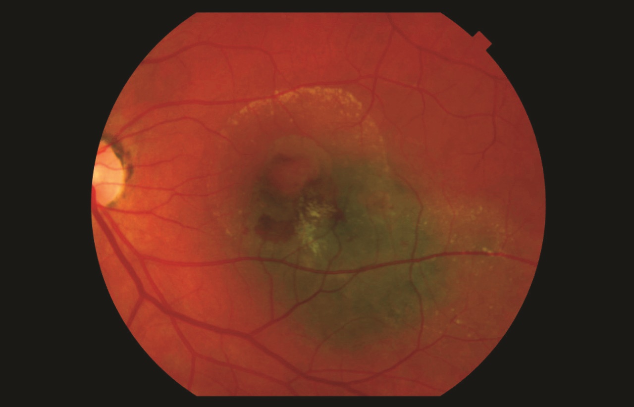 Choroidal Nevus