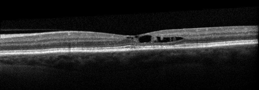 Idiopathic Juxtafoveal Retinal Telangiectasis