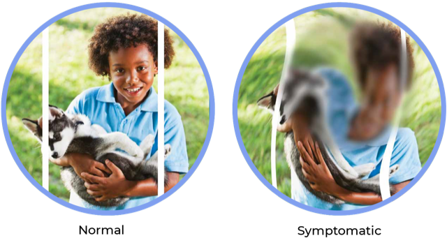 Age related Macular Degeneration The American Society Of Retina 